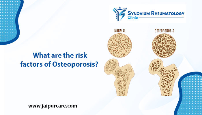What are the risk factors of Osteoporosis? | Synovium Rheumatology